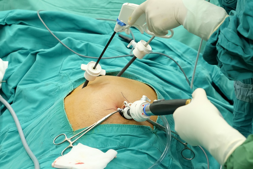 How Soon Can I Take A Bath After Laparoscopic Surgery At Jennette Ince Blog How Soon Can I Take A Bath After Laparoscopic Surgery At Jennette Ince Blog